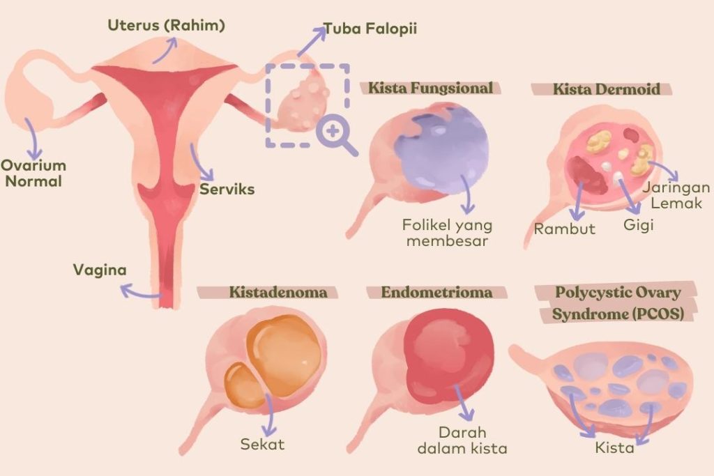 5 Kista yang Sering Terjadi di Dalam Organ Reproduksi Wanita