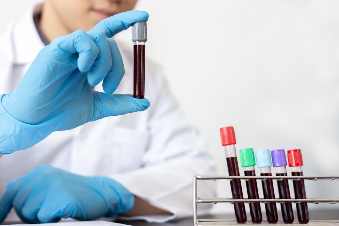 Tes AMH (Anti-Mullerian Hormone) Untuk Program Hamil