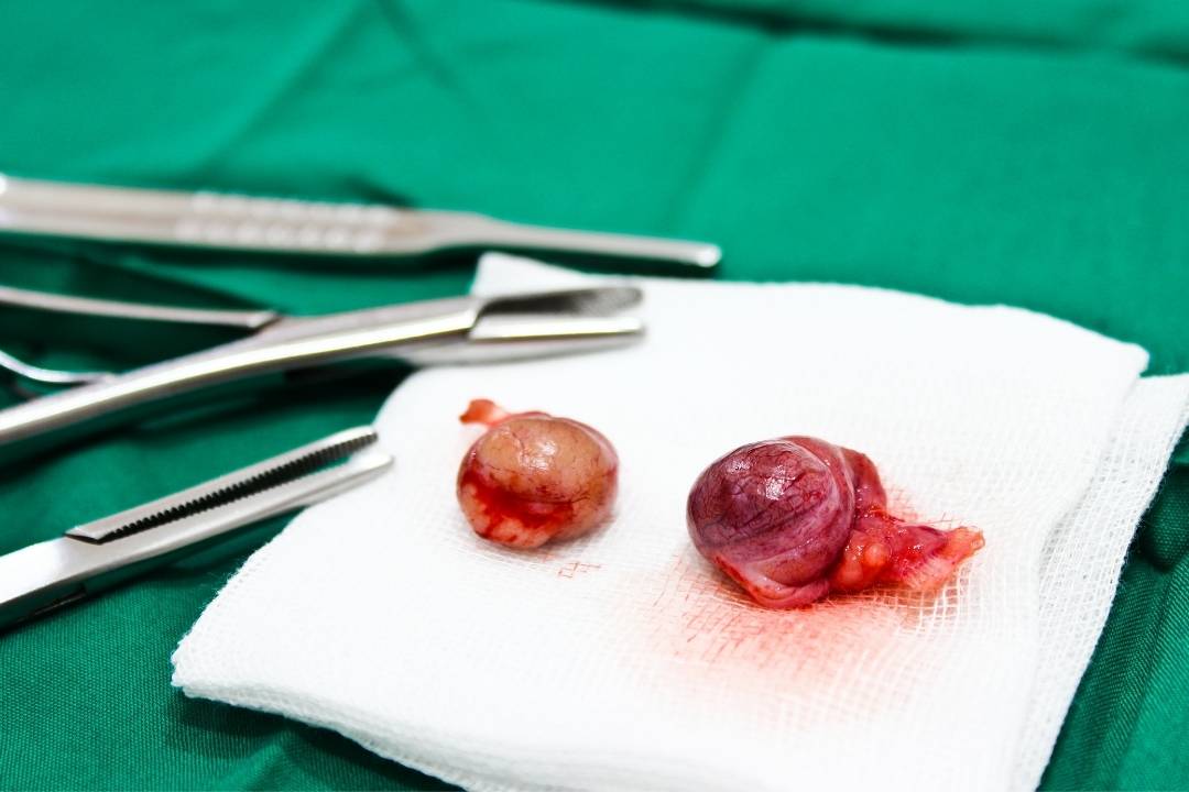 Epididimitis – Gejala, Penyebab, Komplikasi, Cara Mengobati