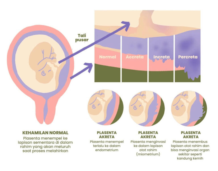 Plasenta Previa, Kala Ari-ari Menutupi Jalan Lahir