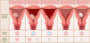 Jenis-Jenis Abortus: Penyebab, Gejala, Diagnosis, dan Cara Penanganannya